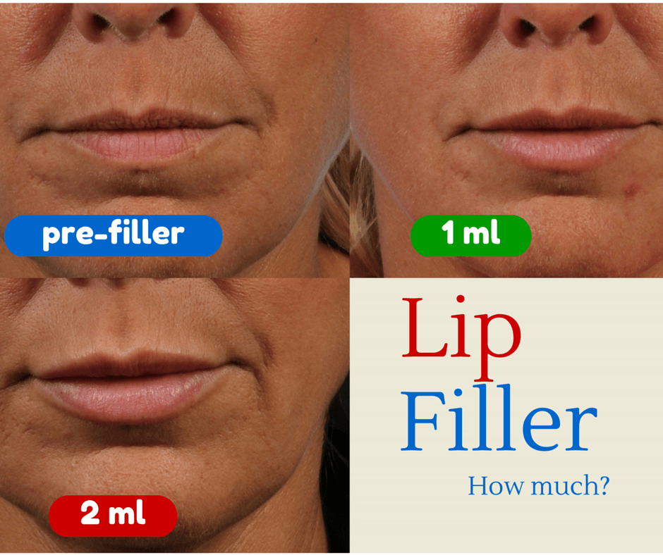 How Much Lip Filler Do You Need How Much Lip Filler Do You Need