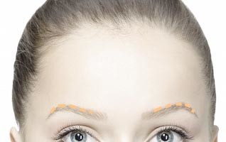 Brow Lift | Dr. Brett Kotlus, Cosmetic Oculoplastic Surgeon, NYC