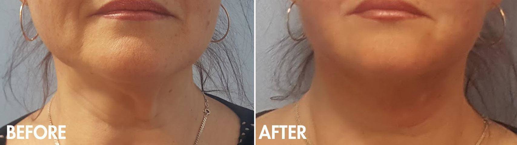 Thread lift NYC - Brett Kotlus M.D.